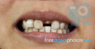 Bad Teeth Stock Photo - Royalty Free Image ID 10053767