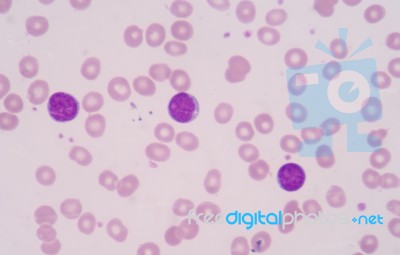 Bone Marrow: Myeloblasts With Auer Rods Seen In Acute Myeloid Le… Stock ...