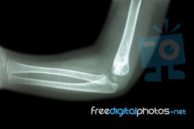 Film X-ray Of Child 's Elbow ( Normal Child 's Elbow ) ( Side View ...
