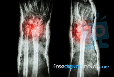 Colles fracture cast position - hapery