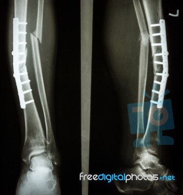 Fracture Shaft Of Tibia And Fibula Stock Photo - Royalty Free Image ID ...