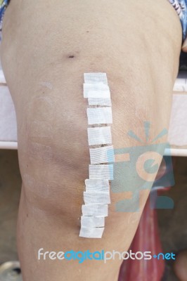 Knee Replacement Incision Stock Photo - Royalty Free Image ID 100165656