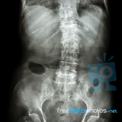 Spondylosis Xray